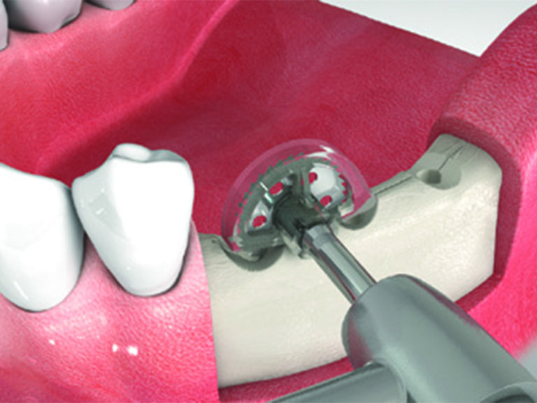 ⭐ Ridge Wider Kit, expansor de cresta alveolar - Recursos Médicos