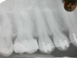 ⭐ Microtornillos Bio-Tack modelo botón con agujero - Recursos Médicos