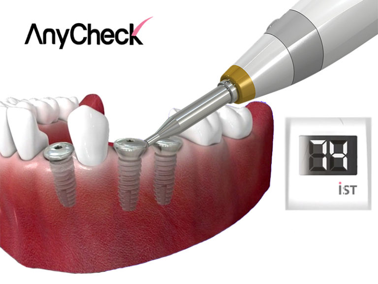 ⭐ AnyCheck medidor de estabilidad de implantes - Recursos Médicos